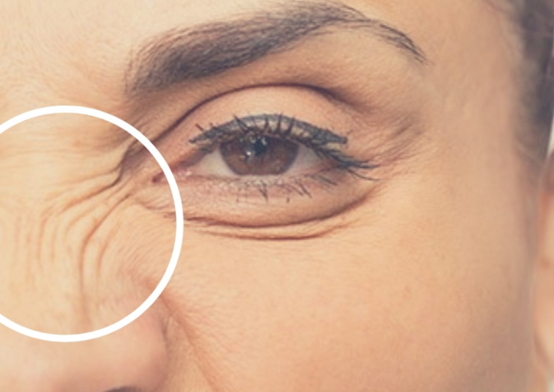 Bunny Lines | Clinic 1 - Colchester's Leading Aesthetics Clinic